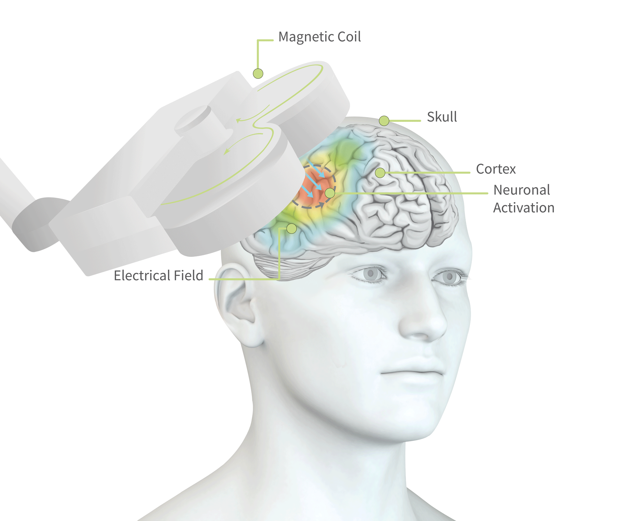 rTMS Treatment: Effective TMS Therapy